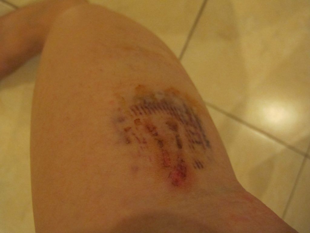 Dog Bites & Rabies Shots