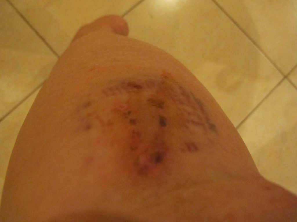 Dog Bites & Rabies Shots