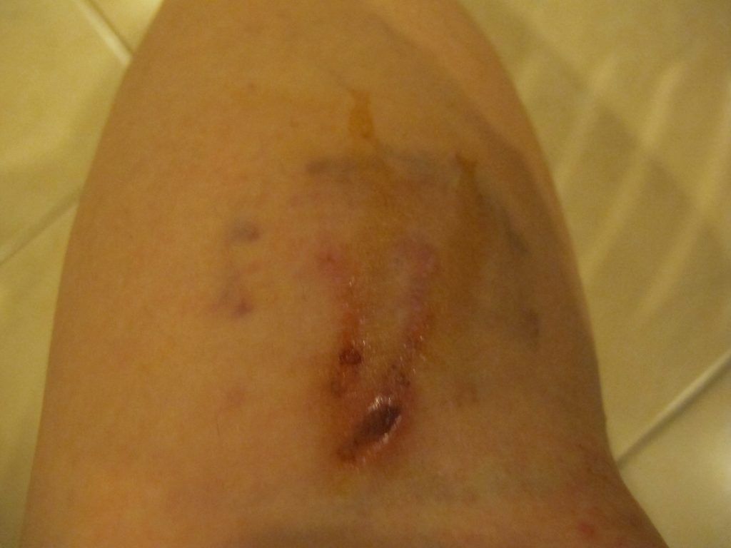 Dog Bites & Rabies Shots